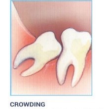 Wisdom teeth Greater Houston